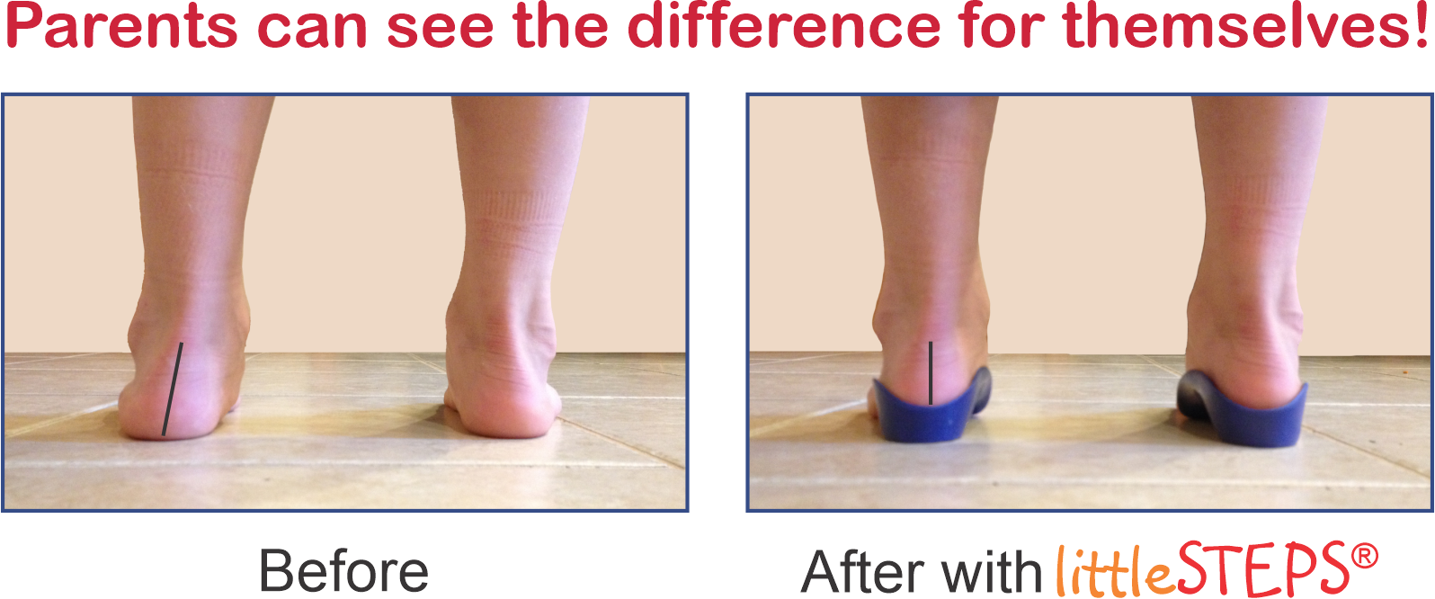 littleSTEPS® Foot Orthotics from NOLARO24™ LLC