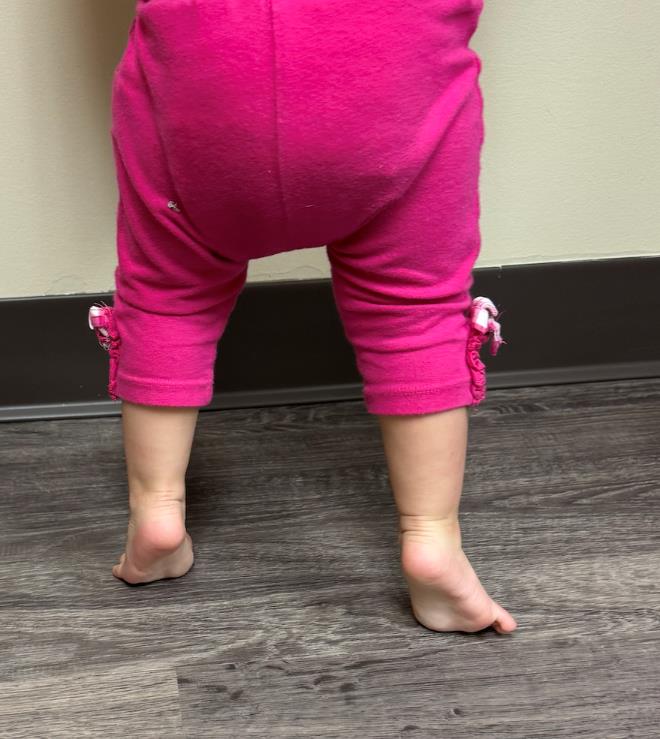 Case Study for Toe Walking – Nolaro24 Blog